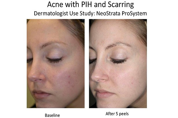Neostrata ProSystem Peels – Weston Beauty Clinic