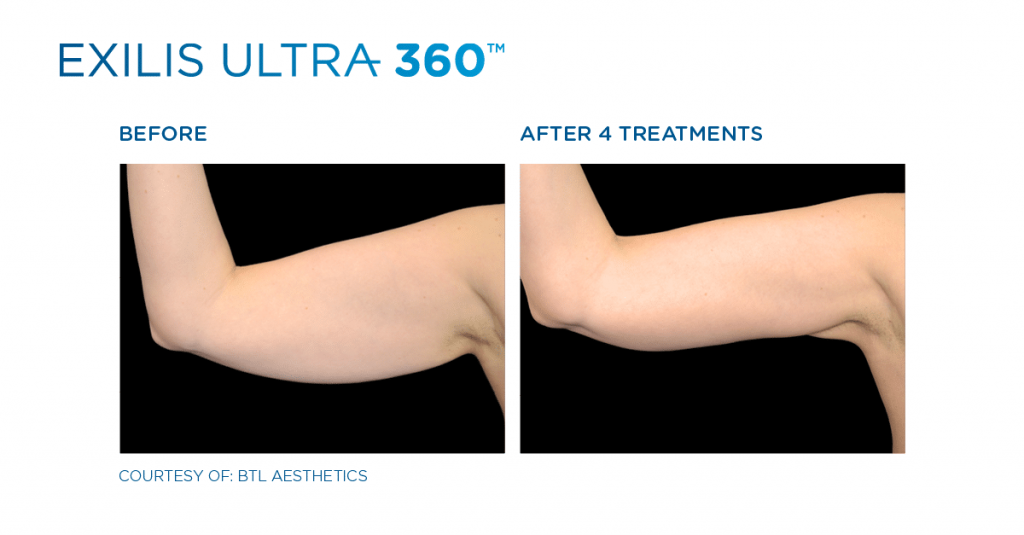 Exilis body – Weston Beauty Clinic